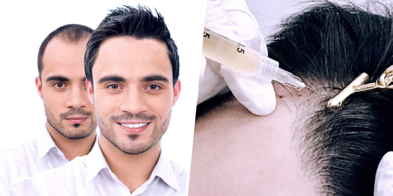 Stem Cell Hair Treatment And Transplant In Malaysia Regrow Hair